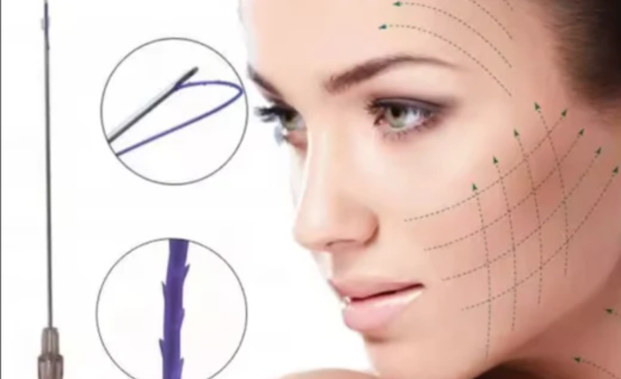 How to Achieve the Fox Eyes Look with Thread Lift – diaminyaesthetics