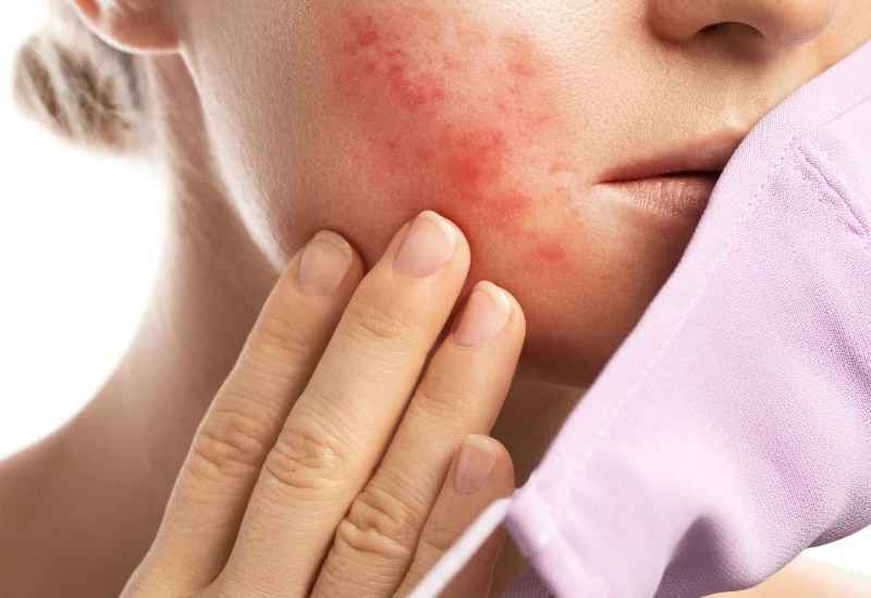 Swelling 2 Weeks After Thread Lift: Is It Normal Or a Warning Sign ...