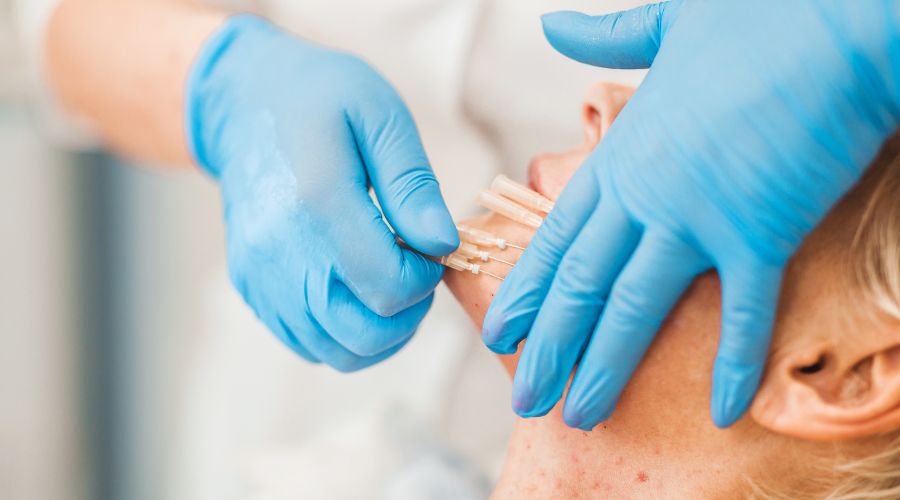 Your Ultimate Guide to Collagen Threads for Wrinkles – diaminyaesthetics