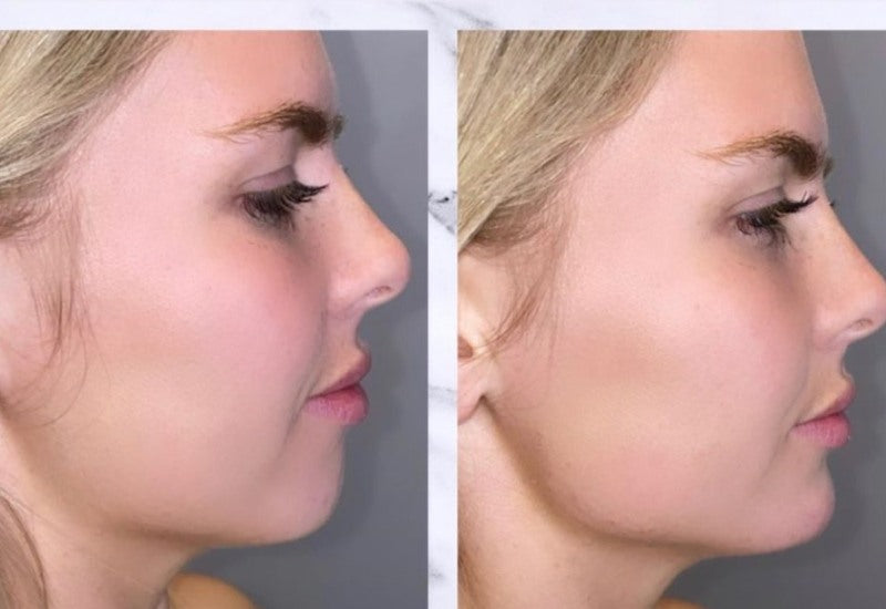 PDO Thread Lift for Jowls: Before and After Results – diaminyaesthetics