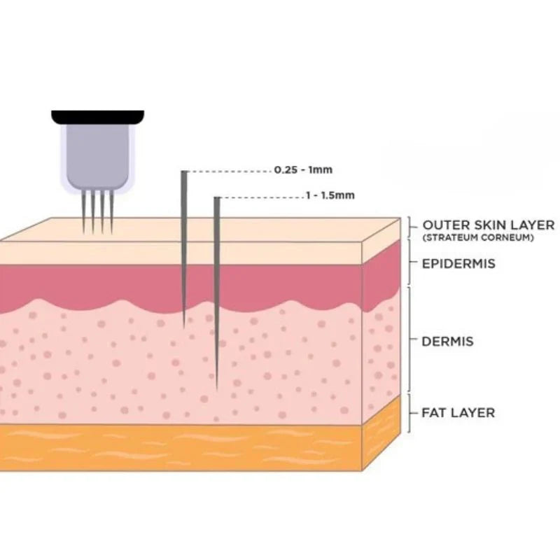 Microneedling Depth for Collagen Production: How Deep Should You Go ...