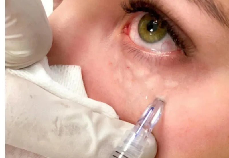 Nanosoft Treatment: the Latest Skin Care Technology – diaminyaesthetics