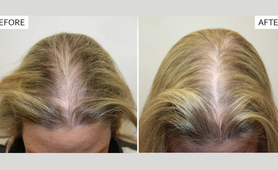 What are PDO Threads for Hair Growth? – diaminyaesthetics