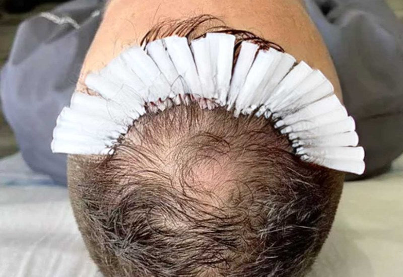 PDO Threads for Hair Growth Side Effects—What You Should Know ...