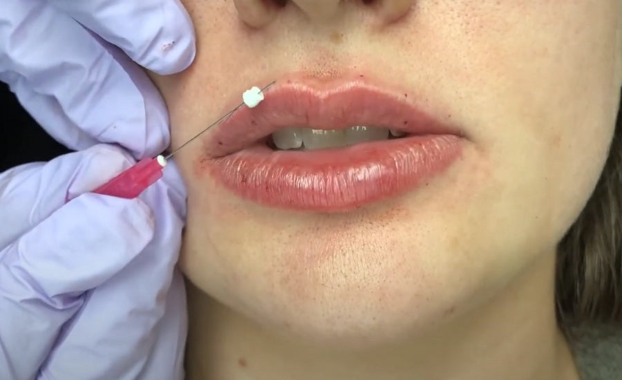 PDO Threads Lips Before and After – diaminyaesthetics