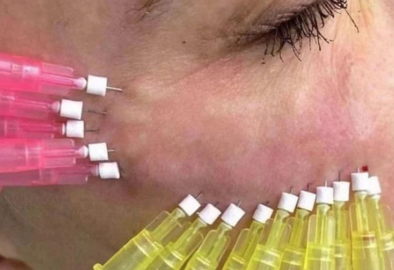 PDO Thread Lifting for Tear Trough Rejuvenation – diaminyaesthetics