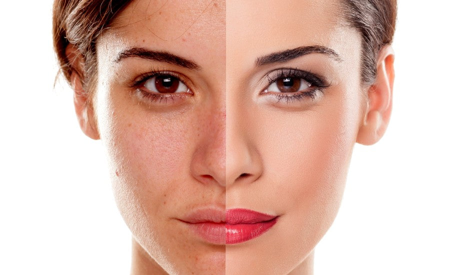 Does Microneedling Reduce Scars, Spots, and Lines? – diaminyaesthetics