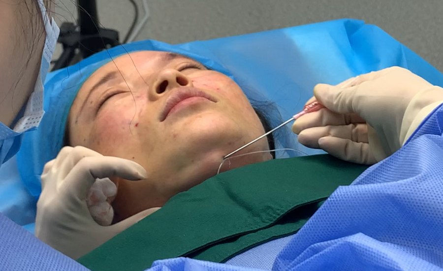 An Ultimate Guide to Cog Thread Lifting – diaminyaesthetics