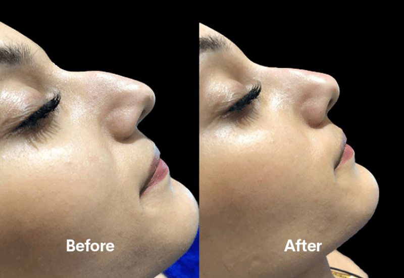 Réduction du nez sans chirurgie : guide complet – diaminyaesthetics