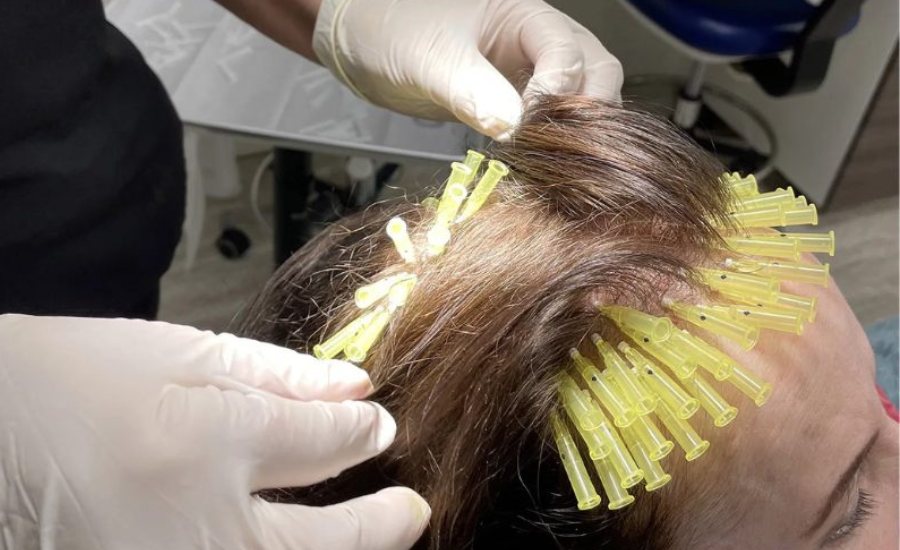 How Much Do PDO Threads for Hair Growth Cost? – diaminyaesthetics