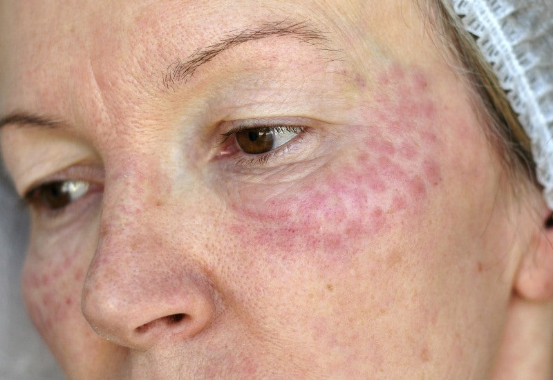 Everything You Need to Know About Redness After Microneedling ...