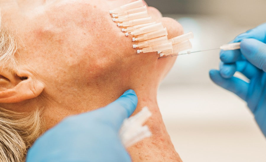 10 PDO Thread Lift Side Effects to be Aware of – diaminyaesthetics