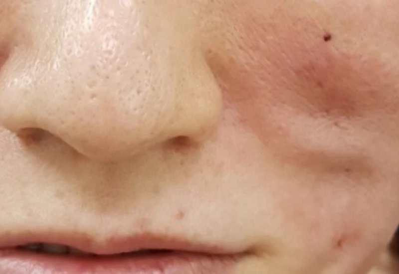 Effective Techniques for Dissolving PDO Threads Safely and Successfull ...