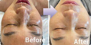 Diaminy Nanosoft Needle 3 Pin for Mesotherapy Injections | Box of 20pc ...